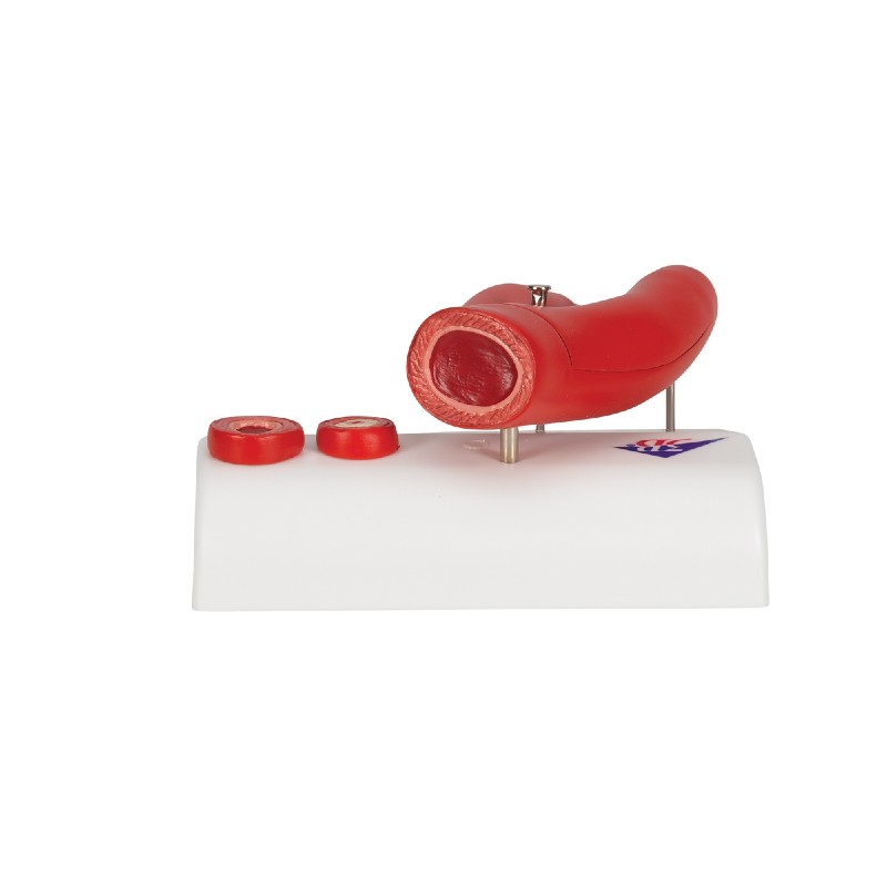 2-Part Atherosclerosis Model w/ Artery | Health and Care